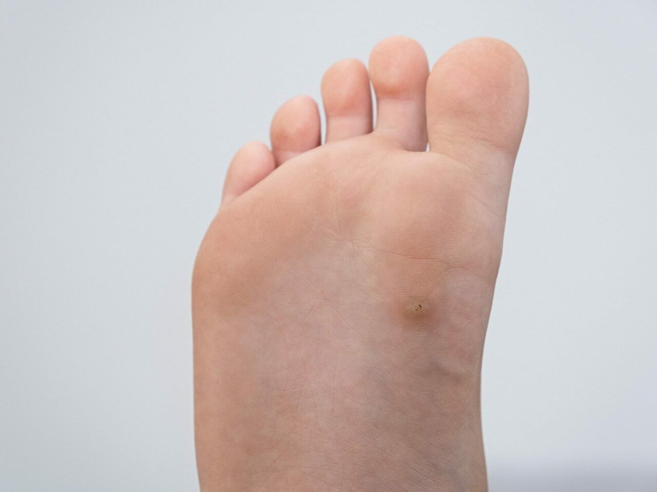 Brodawka wirusowa. Przyczyny, objawy i leczenie - Dbam o siebie