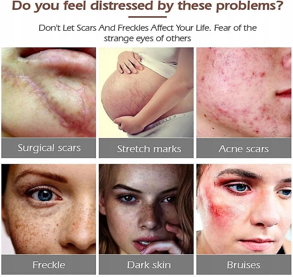 Acne Scar Removal Cream Gel Stretch Marks Remove - Ceny i opinie - Ceneo.pl