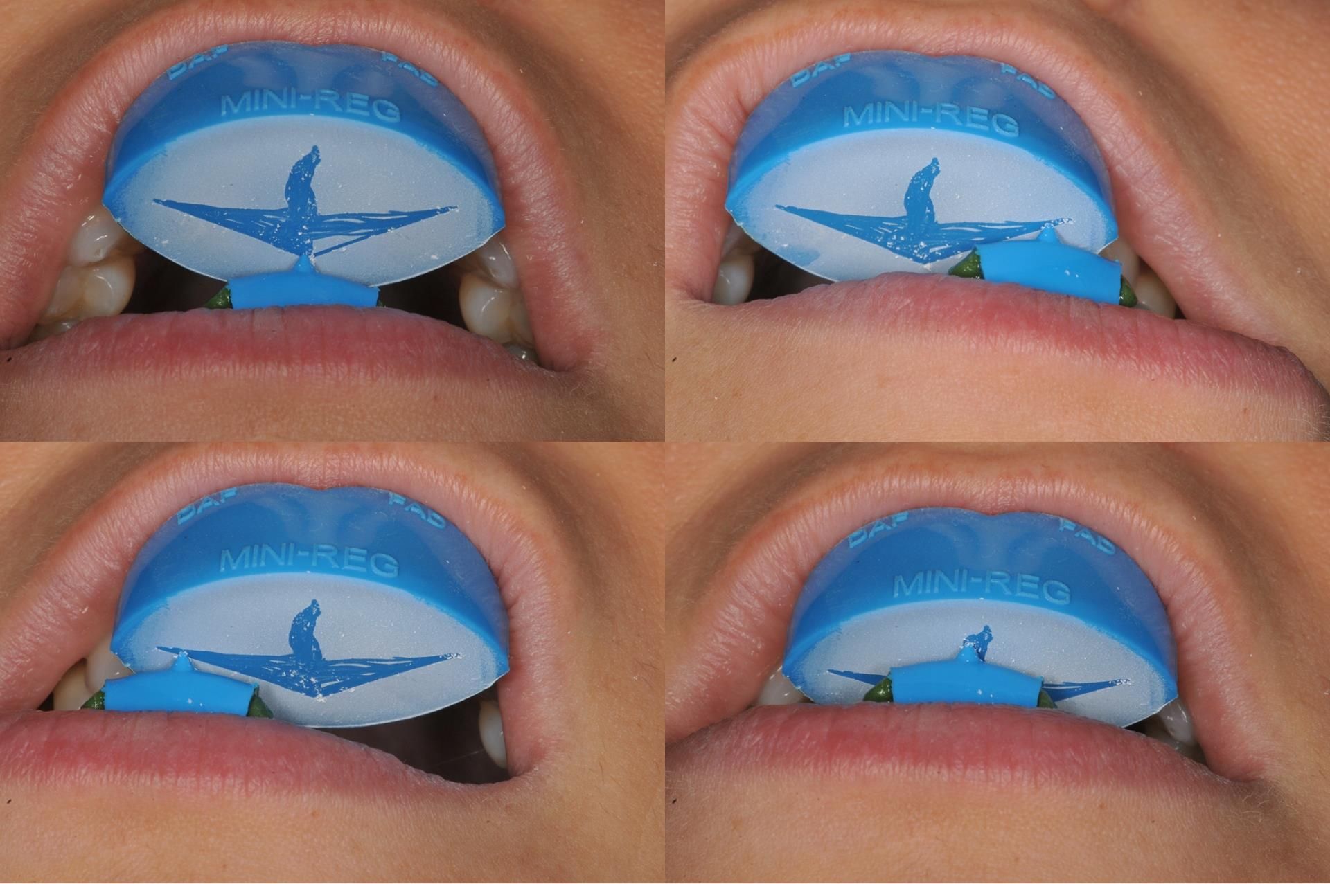 Drobne akcesoria medyczne Dentrade Zestaw Afr Mini Reg - Ceny i opinie ...