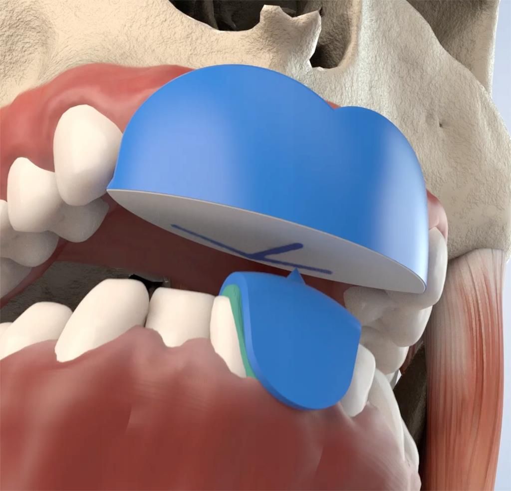 Drobne akcesoria medyczne Dentrade Zestaw Afr Mini Reg - Ceny i opinie ...
