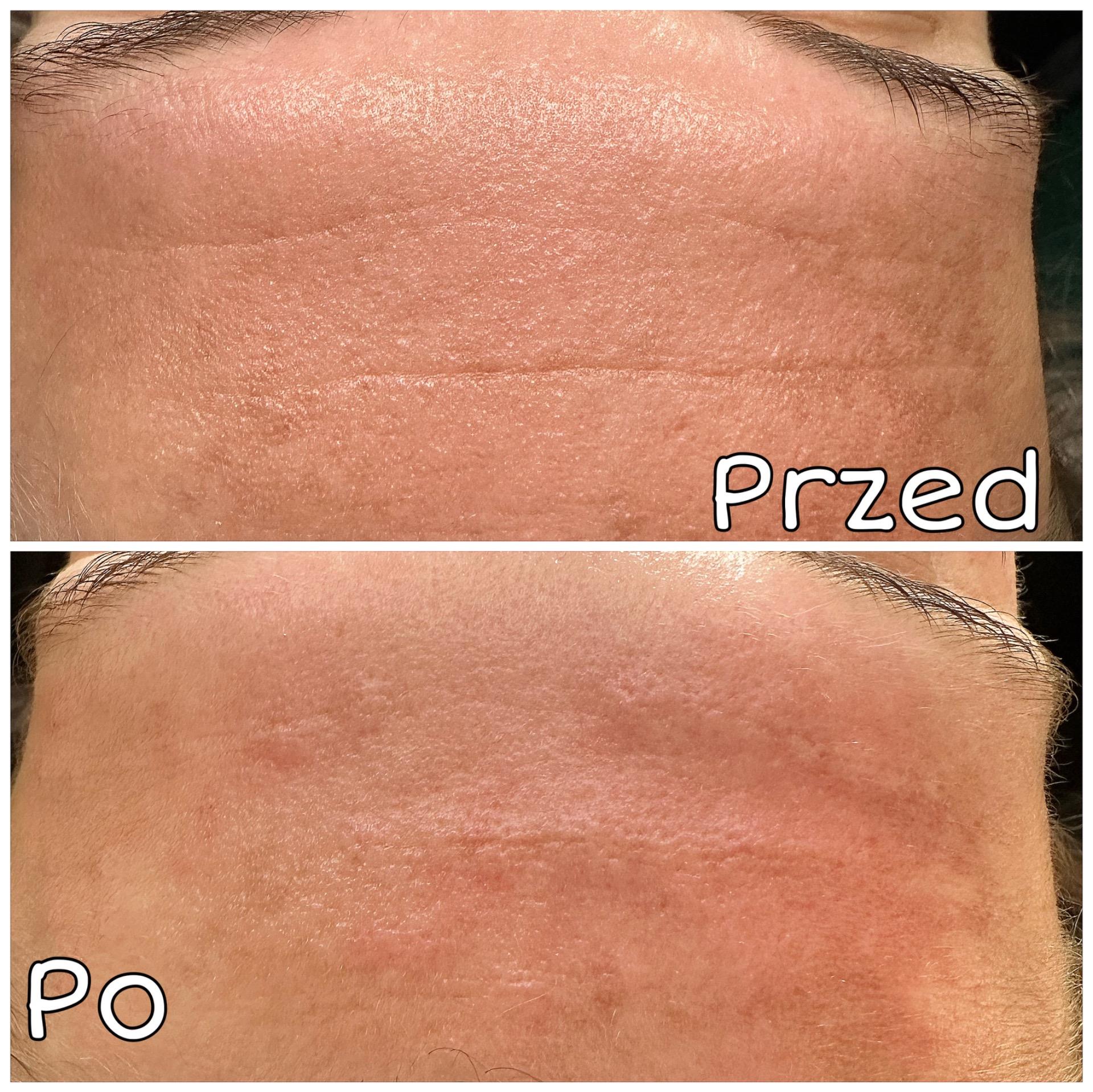 Venome Meso Botox-Like Btx 5Ml - Ceny i opinie - Ceneo.pl